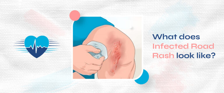 What Does Infected Road Rash Look Like? - Telemedicine in FL, WA, IL ...